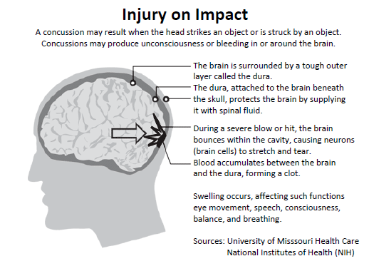 concussion-brain-injury-memory-loss | MemoryHealthCheck
